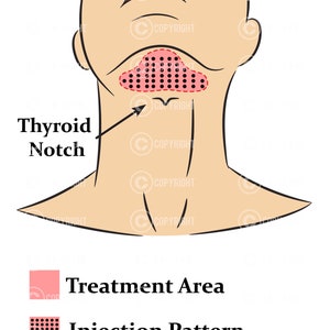 Fat Dissolving Injection Pattern | Aqualyx | Deso | Lipolab | Botox ...