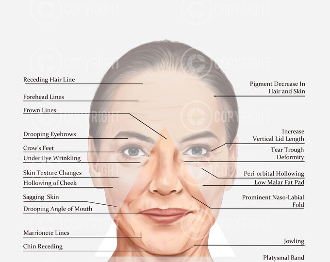Botox Injection Points on Muscle Anatomy | Botox & Filler Injector ...