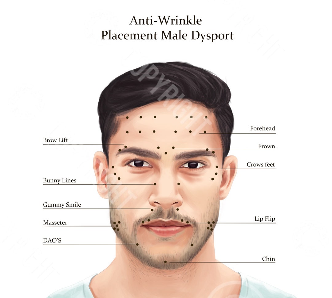 Male Dysport Injection Points | Botox & Filler Injector | Anatomy ...