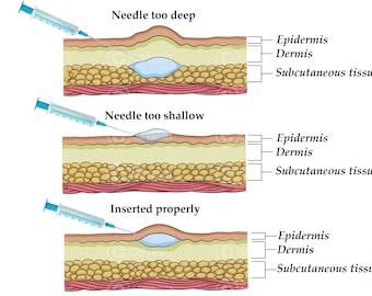 Male BOTOX Injection Points Bundle Botox & Filler Injector Anatomy ...