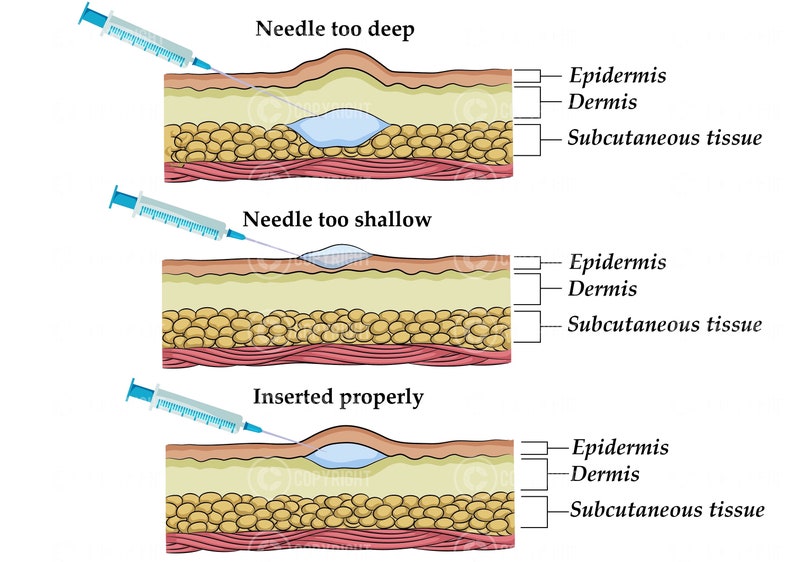 Intradermal Injection Technique| Mesotherapy | Skin Boosters | Botox ...