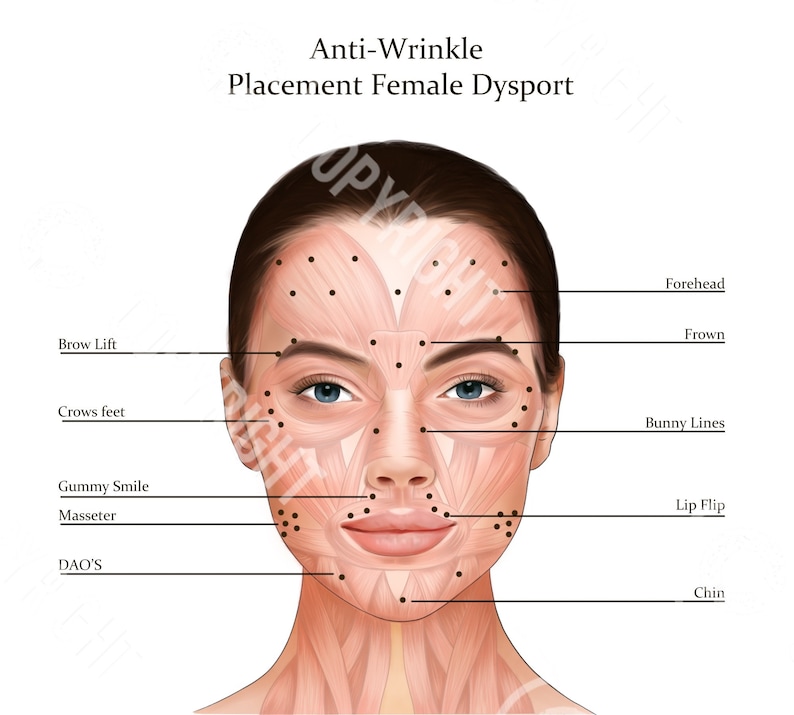Dysport Injection Points Bundle | Botox Filler Injector | Anatomy ...
