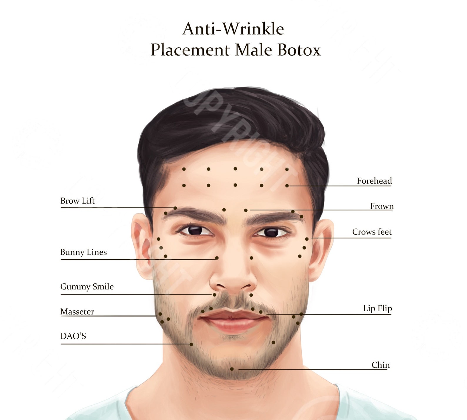 Male BOTOX Injection Points Bundle | Botox & Filler Injector | Anatomy ...
