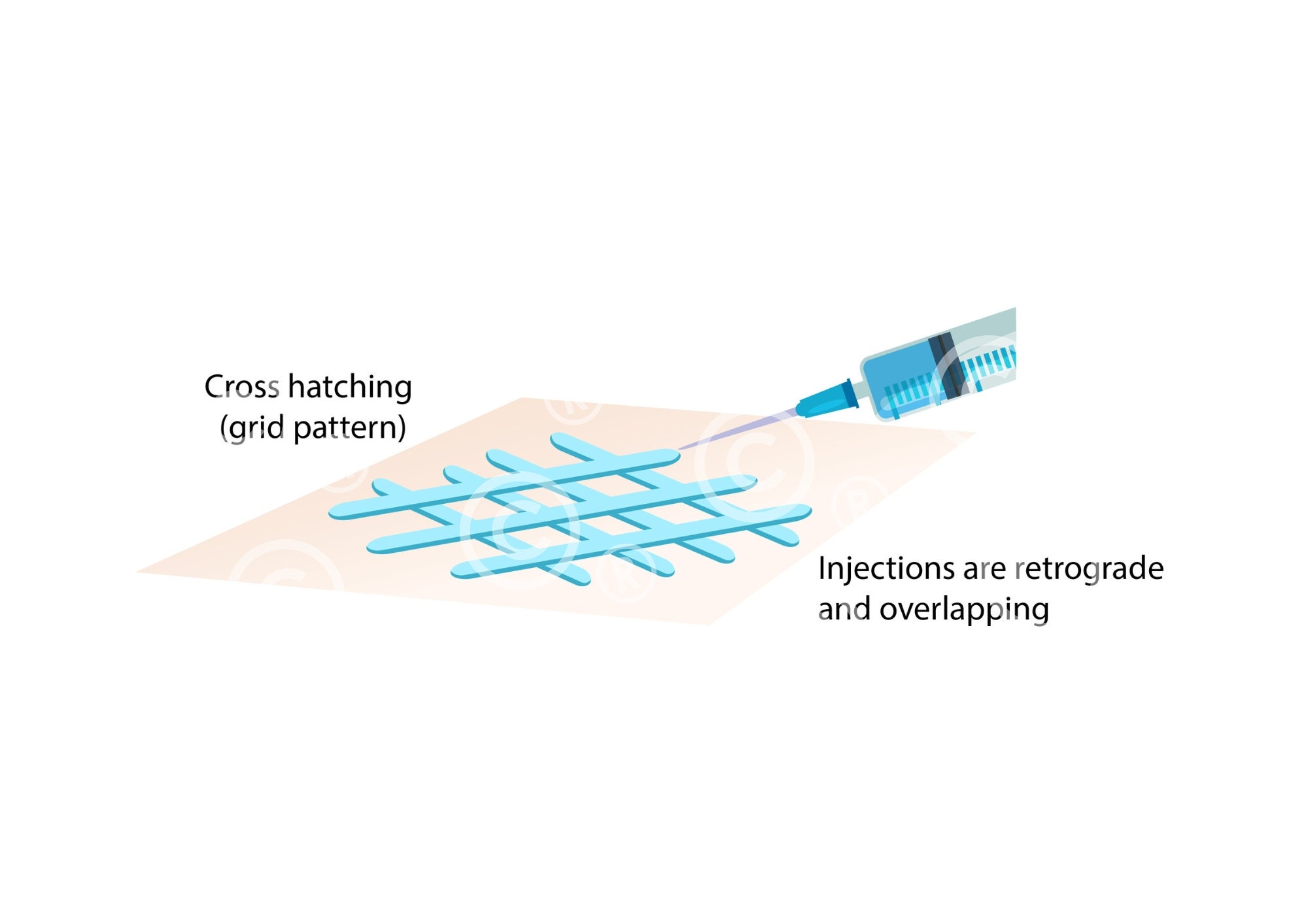 Needle Injection Style and Techniques for Dermal Fillers | Dermal ...