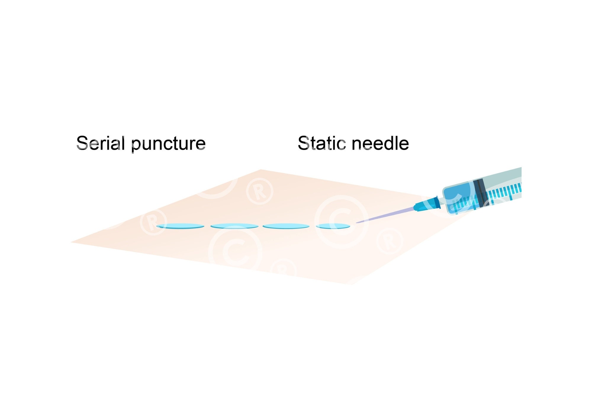 Needle Injection Style and Techniques for Dermal Fillers | Dermal ...