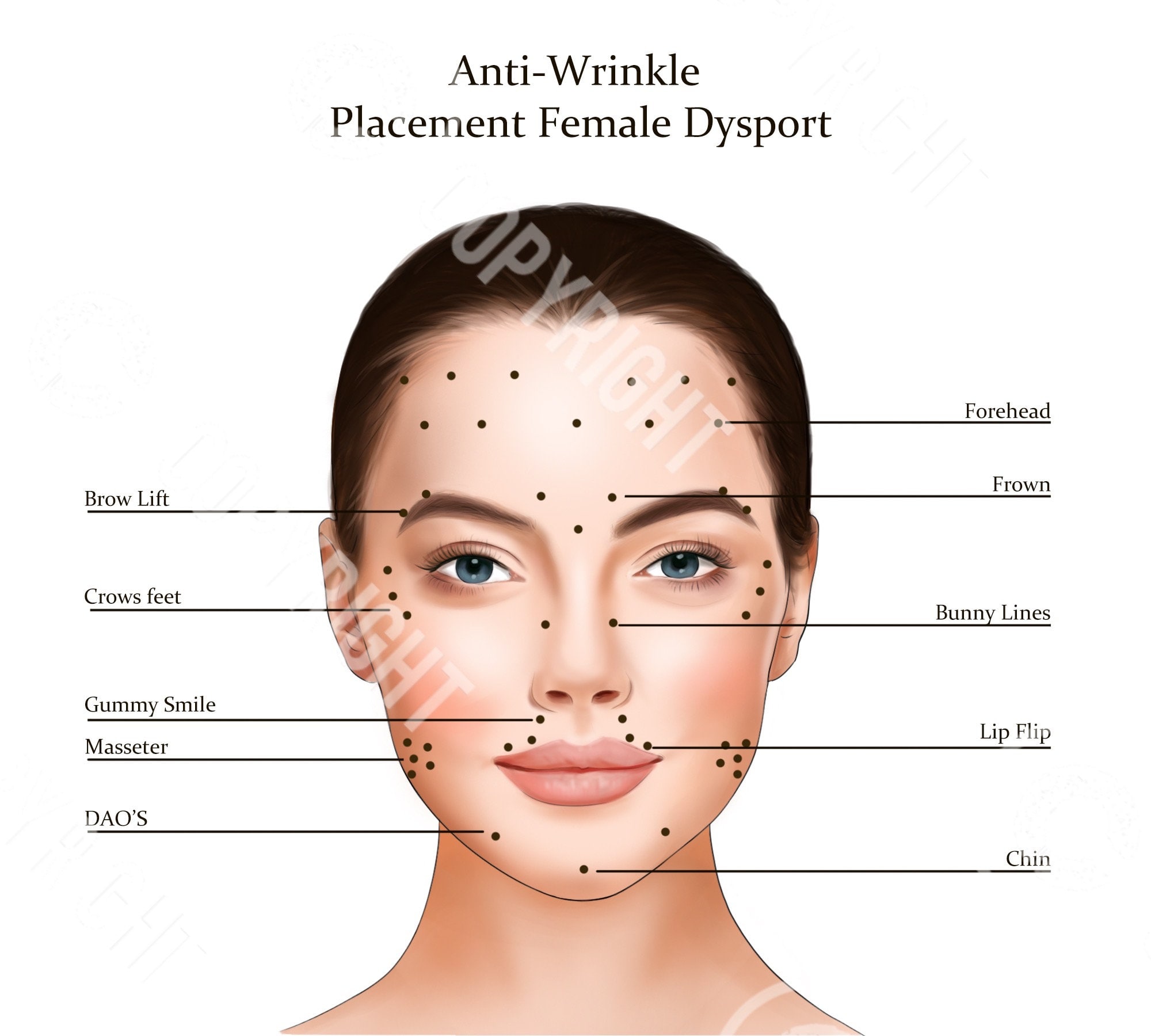 Dysport Injection Points Bundle | Botox Filler Injector | Anatomy ...