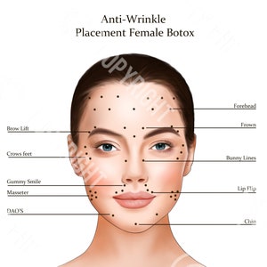 Botox Injection Points Bundle | Botox & Filler Injector | Anatomy | Art ...