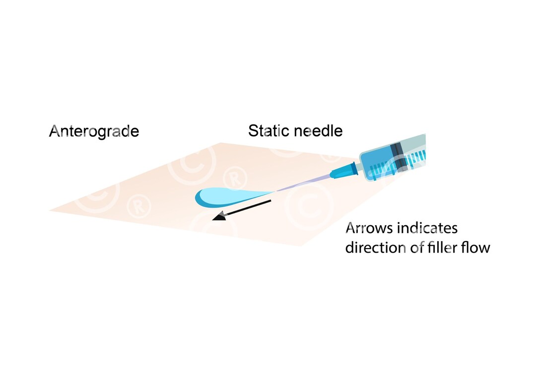 Needle Injection Style and Techniques for Dermal Fillers | Dermal ...