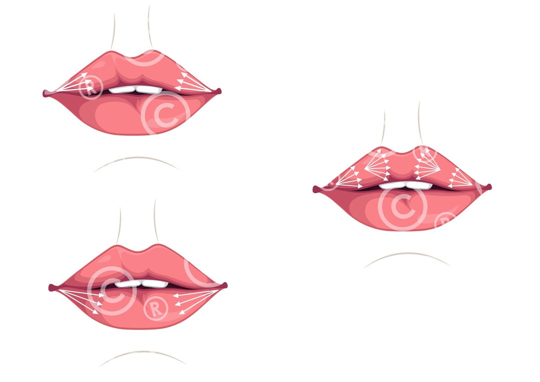 Russian Lip Filler Injection Techniques | Dermal Filler | Illustrations ...