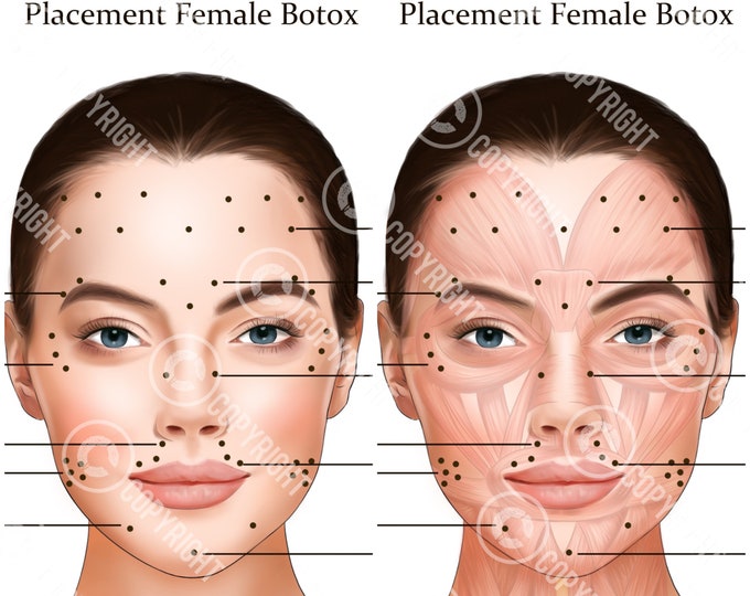 Botox Injection Points Bundle | Botox & Filler Injector | Anatomy | Art ...
