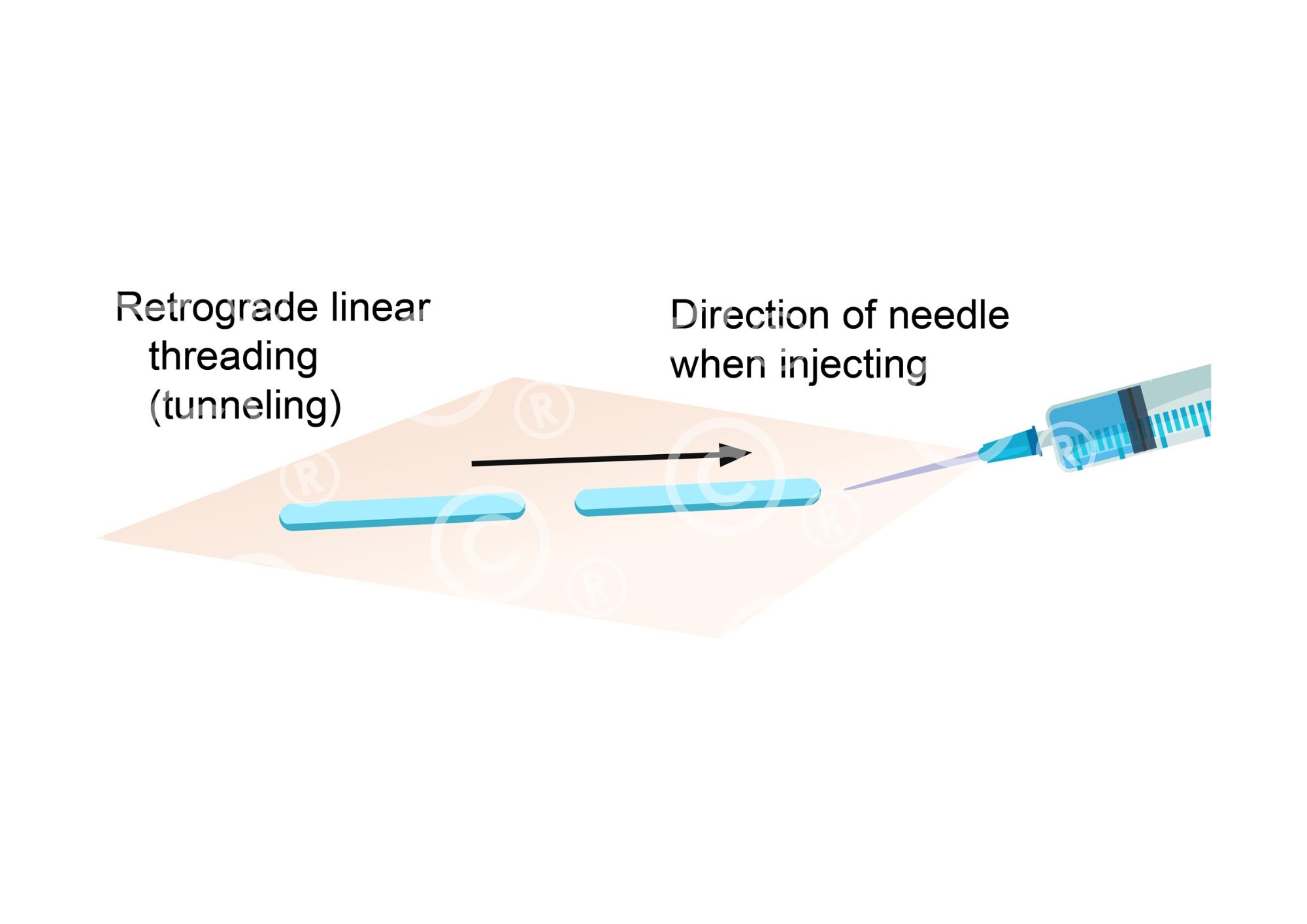 Needle Injection Style and Techniques for Dermal Fillers Dermal Filler ...