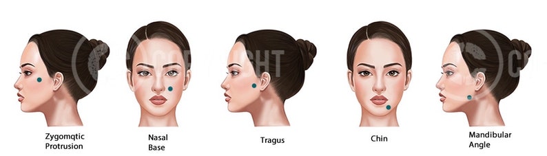 Profhilo Bundle 5 Point BAP Face| 10 Point BAP Neck| Skin Boosters ...