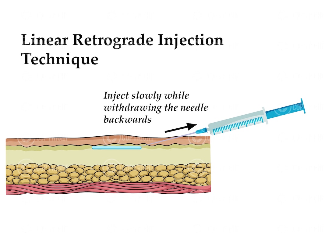 Linear Retrograde Injection Technique | Botox & Filler Injector ...