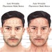 Male BOTOX Injection Points Bundle | Botox & Filler Injector | Anatomy ...