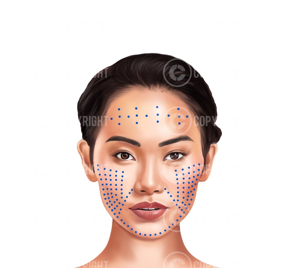 Mesotherapy Injection Patterns | Botox & Filler Injector | Anatomy ...