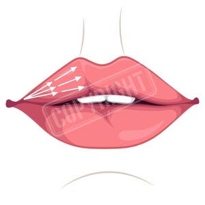 Fundamental Lip Filler Injection Techniques Bundle | Lip Anatomy ...