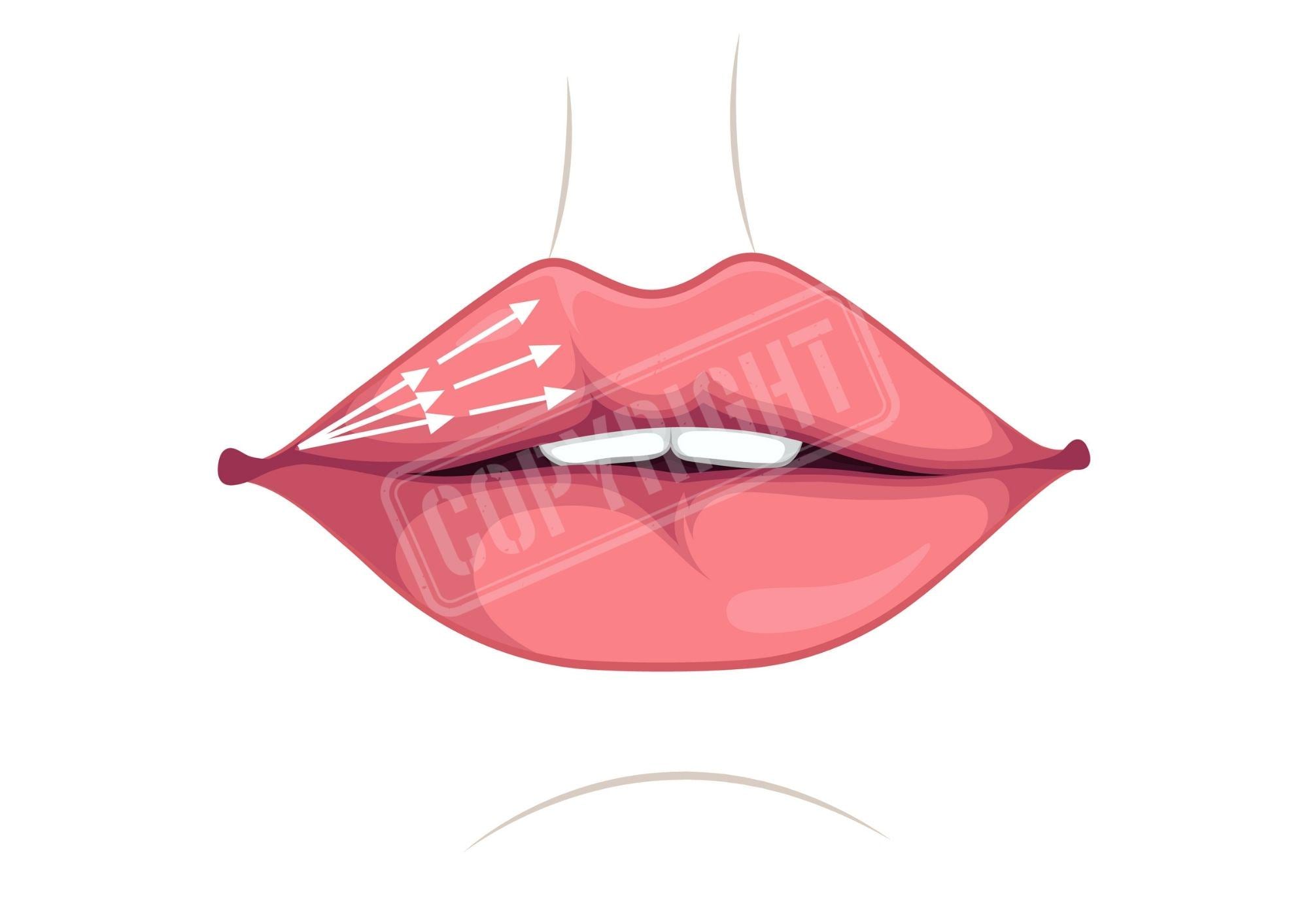 Fundamental Lip Filler Injection Techniques Bundle | Lip Anatomy ...