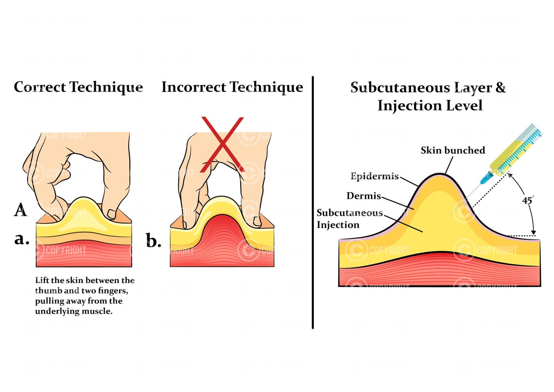 Subcutaneous Injection Technique | Fat Dissolving | Botox & Filler ...