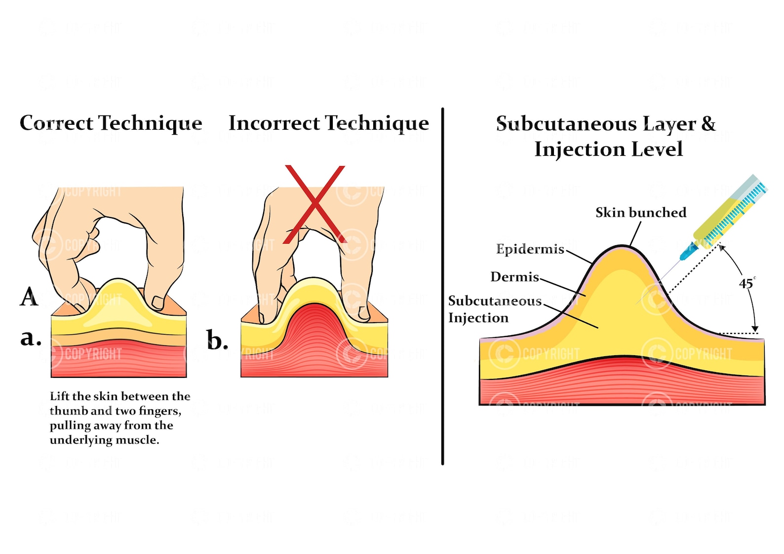 Subcutaneous Injection Technique | Fat Dissolving | Botox & Filler ...