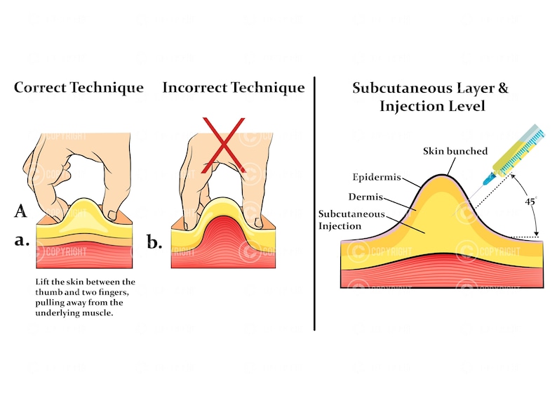 Subcutaneous Injection Technique | Fat Dissolving | Botox & Filler ...