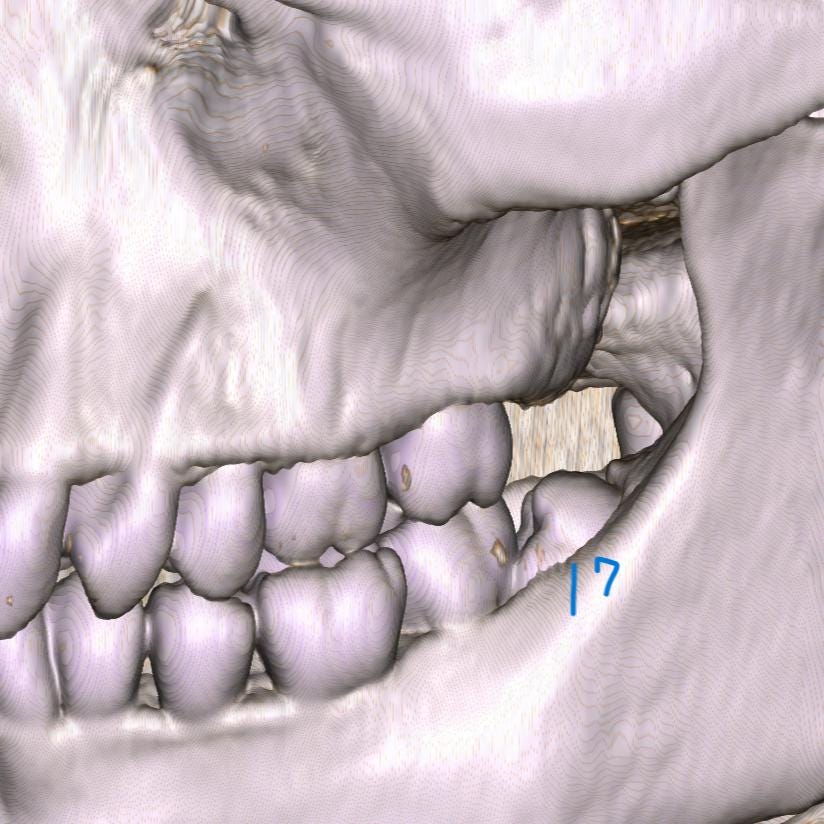 3D Printable Human Teeth Stls From CT Scan - Etsy