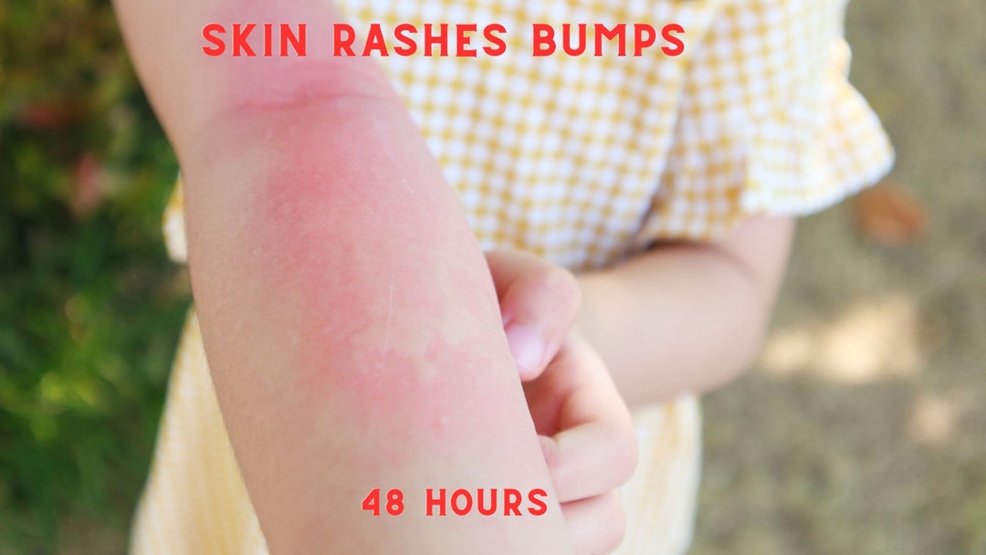 Skin Rashes Hives Red Bumps On Body Emotion Release Sessions - Etsy España