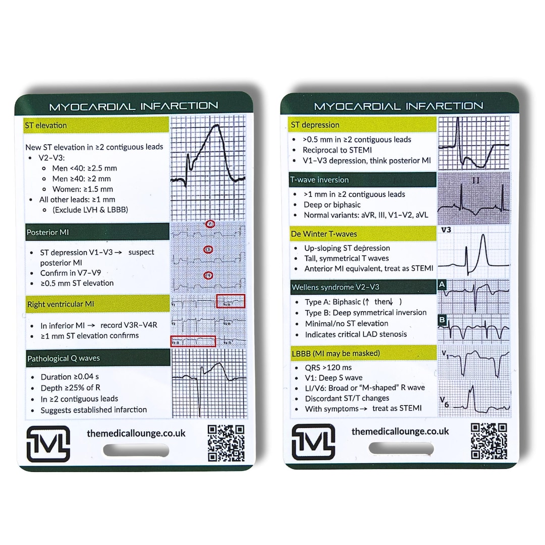 Myocardial Infarction Ecg Reference Card | Ecg Study & Revision Aid for ...