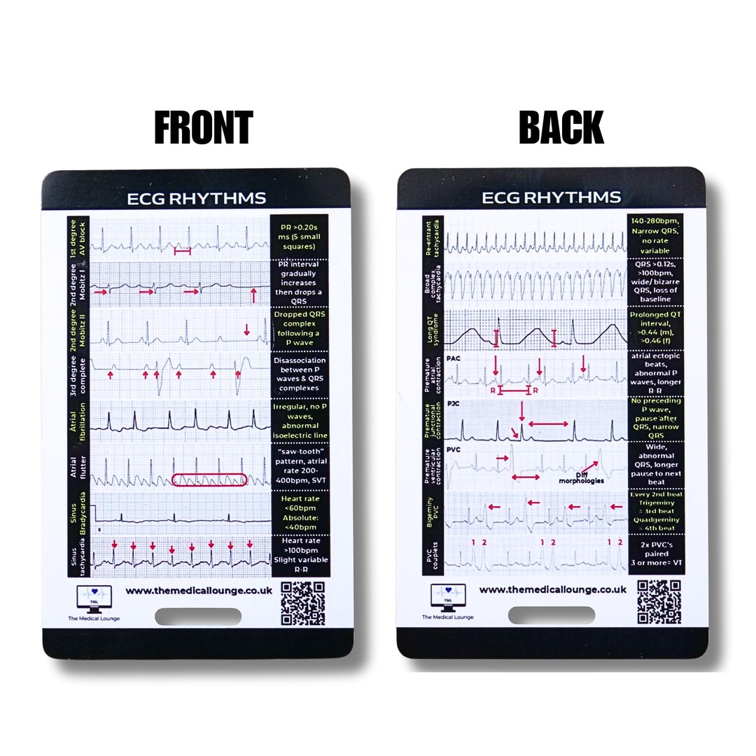 ECG Rhythm Reference Card | 15 Abnormal ECG Strips With Visual Guide ...