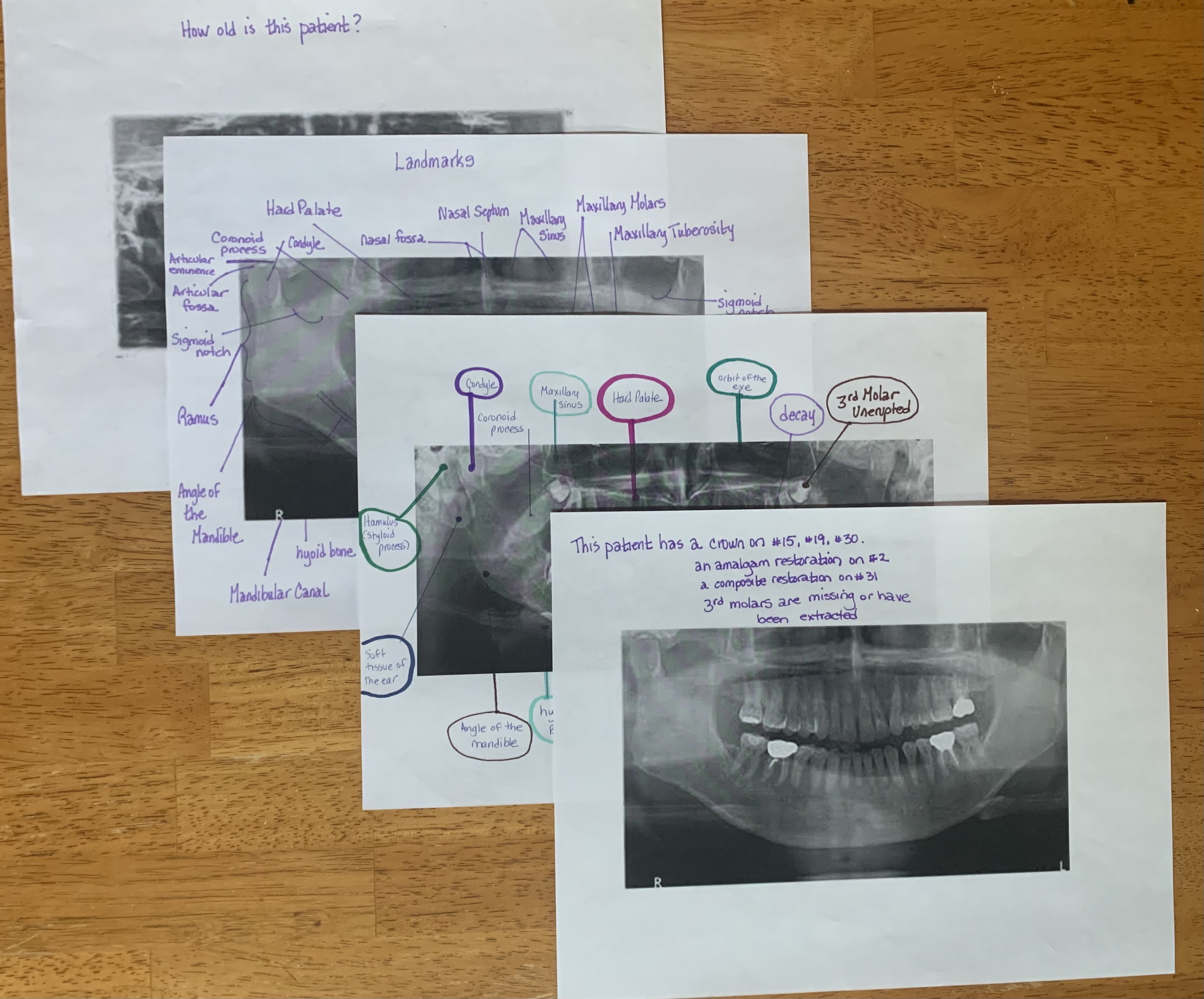 Dental Radiology Flashcards on Conditions and Anatomy - Etsy
