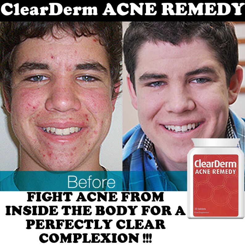 CLEAR DERM Acne Tablets, the No.1 Acne & Spot Treatment 1-a-day - Etsy