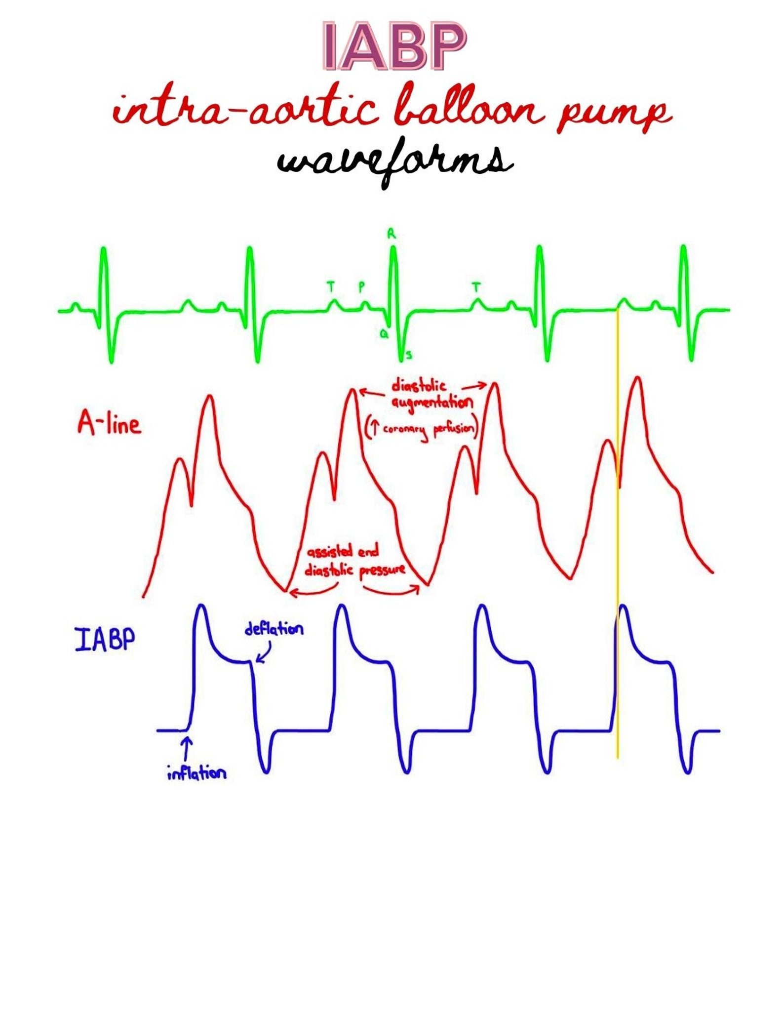 IABP Cheat Sheet: ICU Nursing Notes (PDF Download) - Etsy