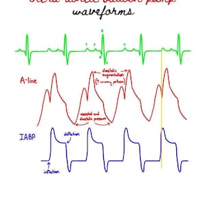 IABP Cheat Sheet: ICU Nursing Notes (PDF Download) - Etsy