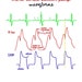 IABP Cheat Sheet: ICU Nursing Notes (PDF Download) - Etsy