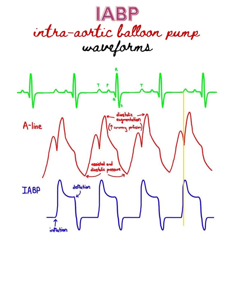 IABP Cheat Sheet, RN Nursing Notes, Balloon Pump Notes, ICU Notes ...