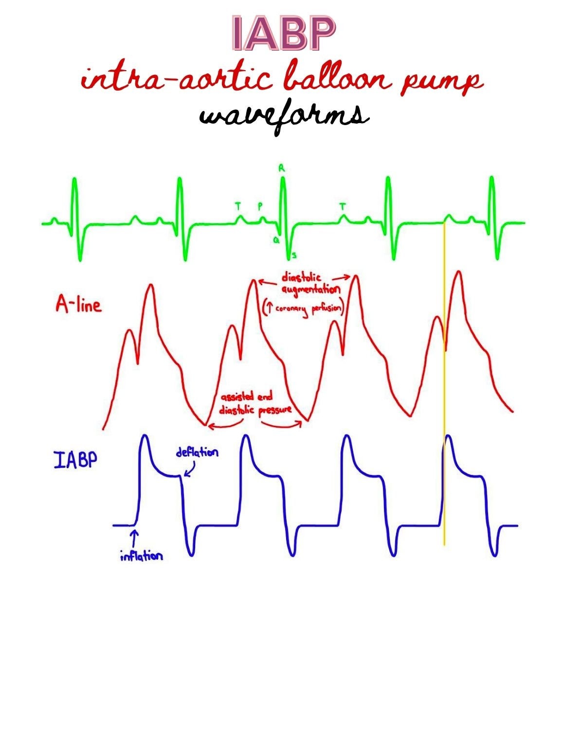 IABP Cheat Sheet, RN Nursing Notes, Balloon Pump Notes, ICU Notes ...