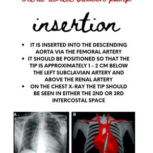 IABP Cheat Sheet: ICU Nursing Notes (PDF Download) - Etsy