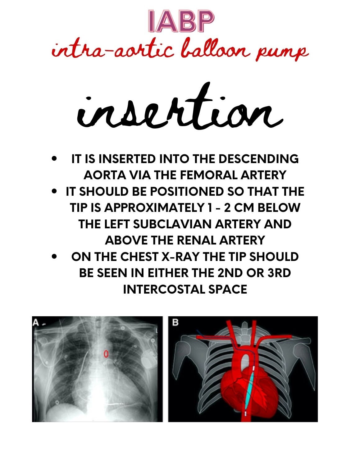 Intra Aortic Balloon Pump Xray
