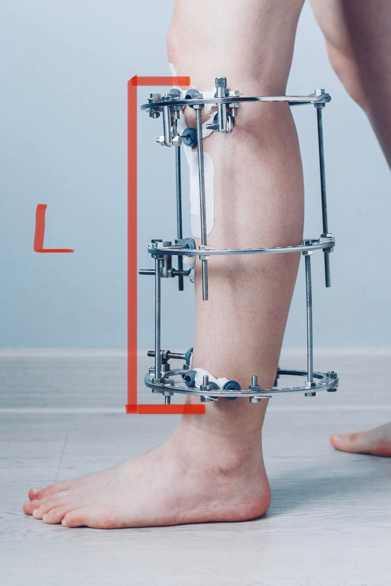 Fixator Covers - Etsy