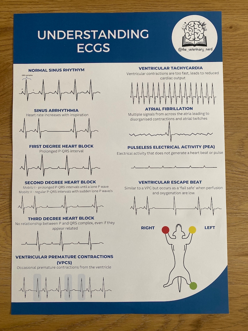 A3 ECG Poster - Etsy