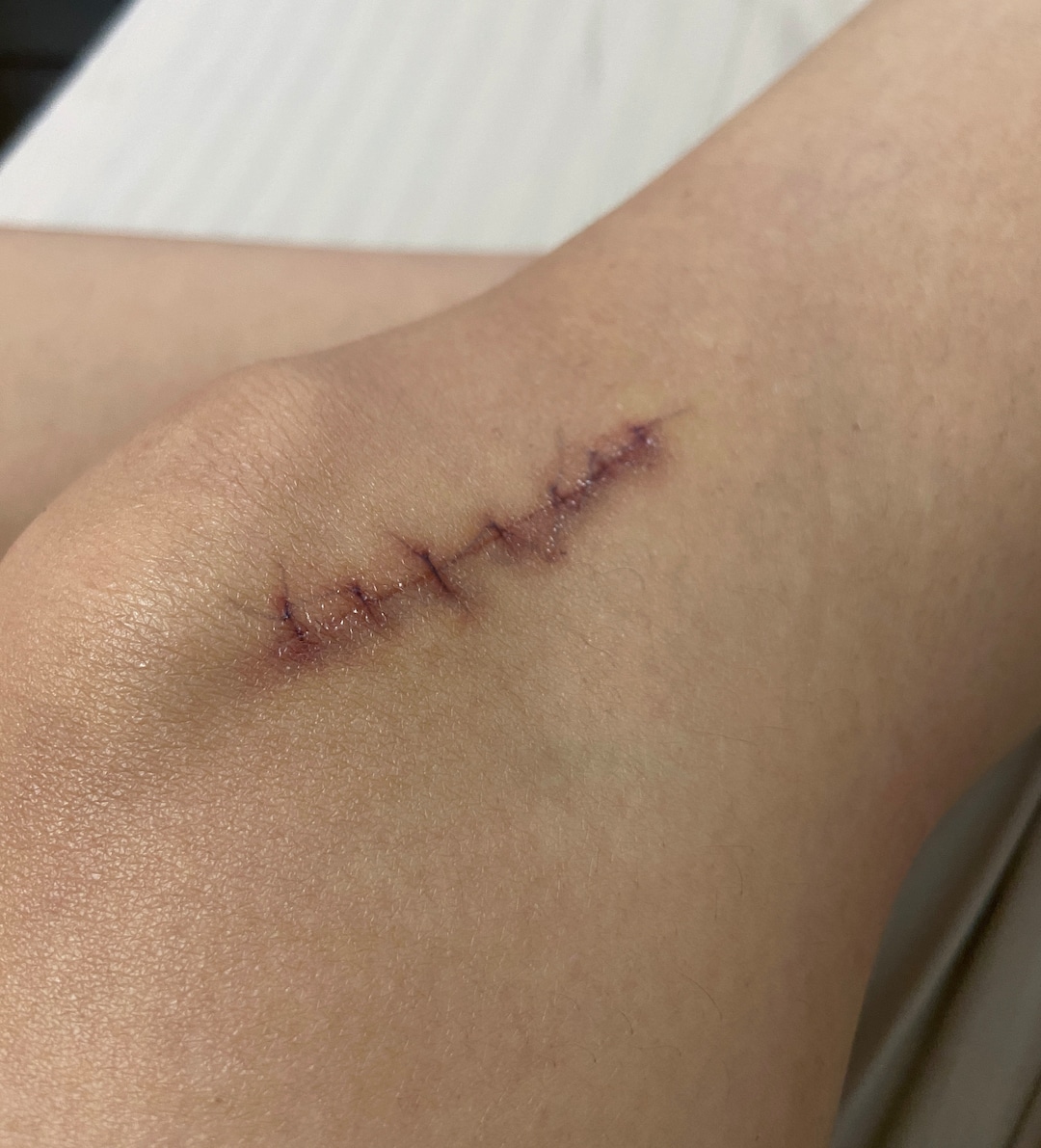 Realistic Temporary Tattoo (keloids and Sutures) for SFX Makeup ...