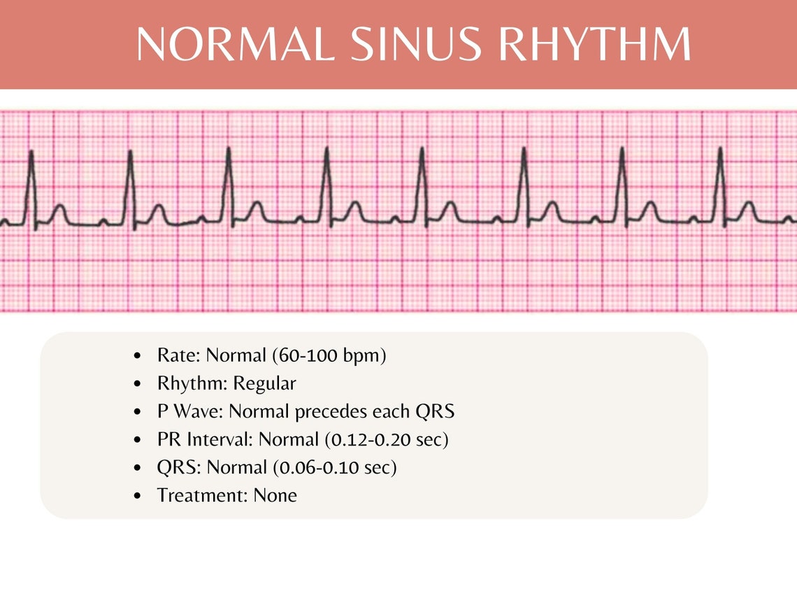 EKG Interpretation 4x6 Flashcards Printable - Etsy EKG Interpretation 4x6 Flashcards Printable - Etsy