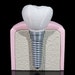 Detailed 3D Printed Dental Implant Model - Etsy