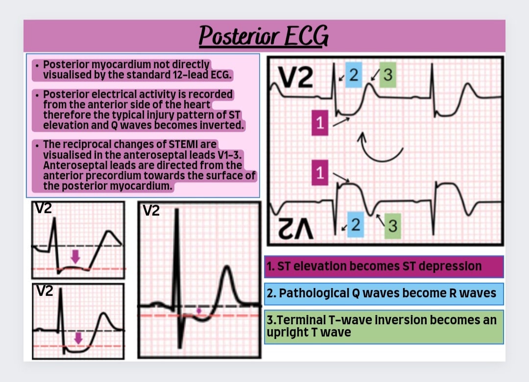 12 Lead ECG Colourful Guide - Etsy
