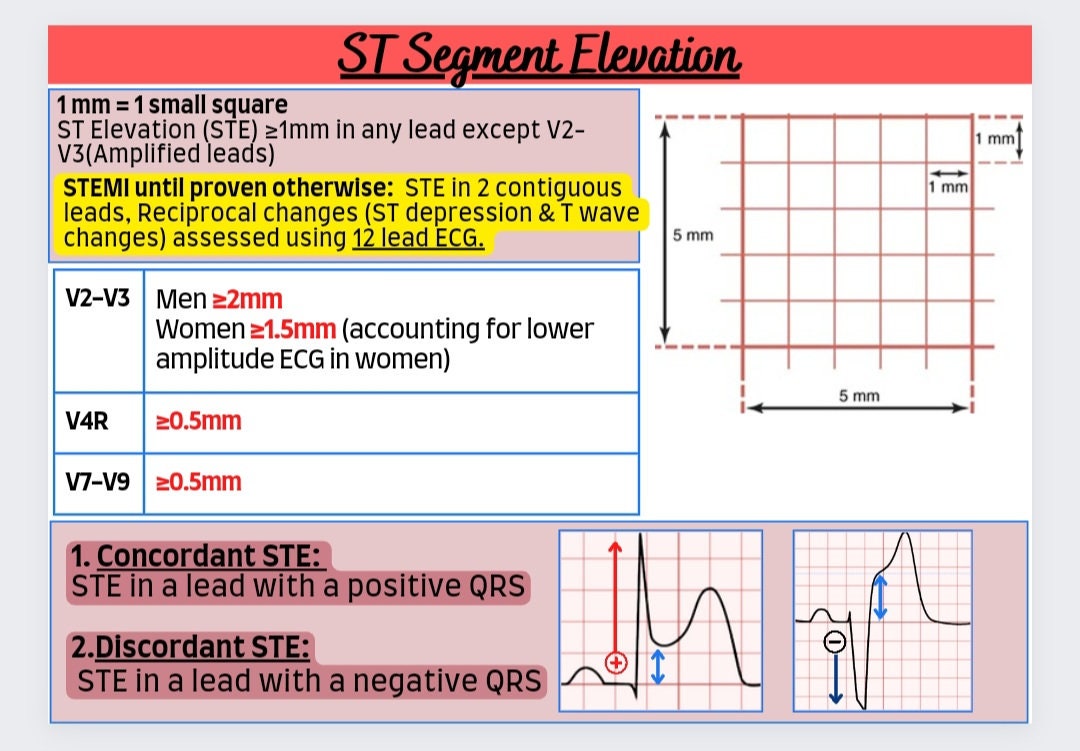 12 Lead ECG Colourful Guide - Etsy
