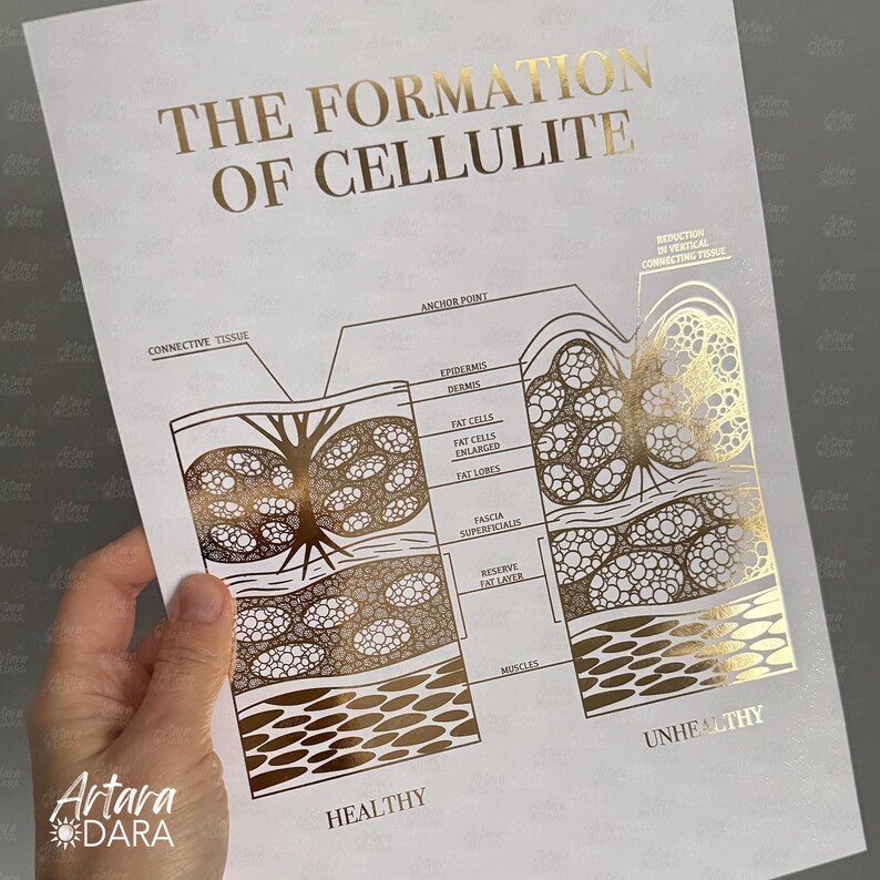 Cellulite Anatomy Poster Set of 3 – Gold Foil Med Spa Wall Art ...