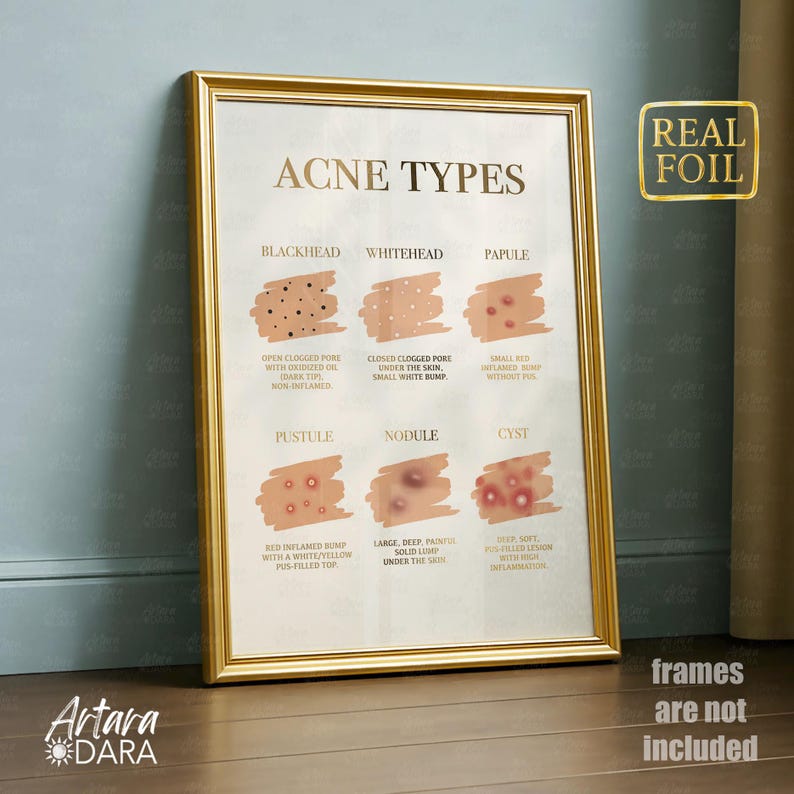 Acne & Skin Poster Set of 4 – Gold Foil Acne Types, Formation, Face Map ...