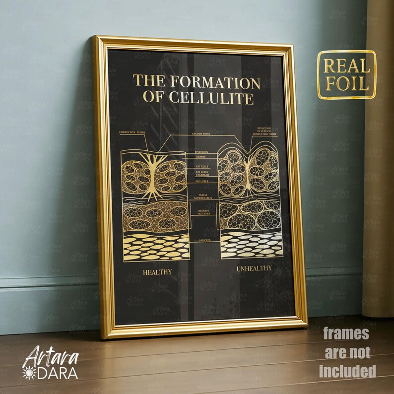 Cellulite Anatomy Poster Set of 3 – Gold Foil Med Spa Wall Art ...