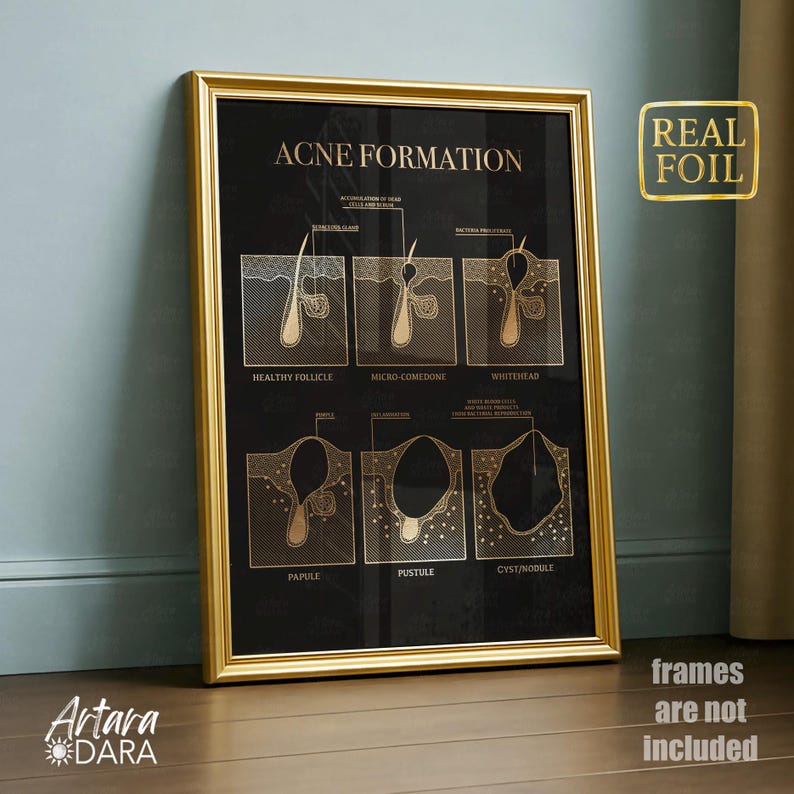 Dermatology Poster Set of 3 – Gold Foil Acne Map, Skin Anatomy & Acne ...