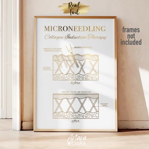 Microneedling Poster, Real Foil Print, Microneedling Tech ...