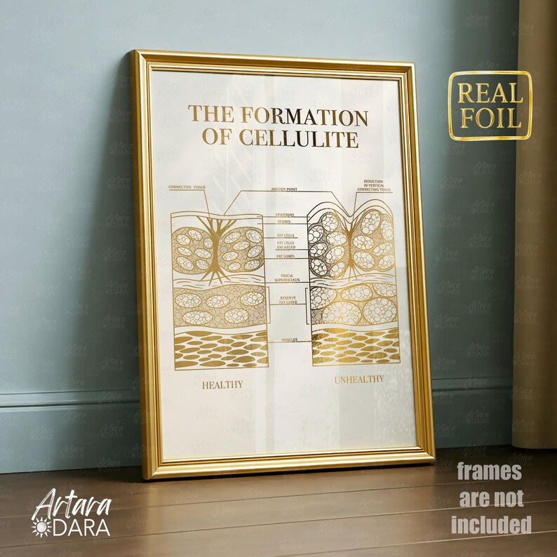 Cellulite Anatomy Poster Set of 3 – Gold Foil Med Spa Wall Art ...